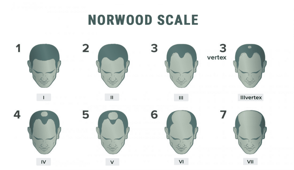 what causes pattern baldness